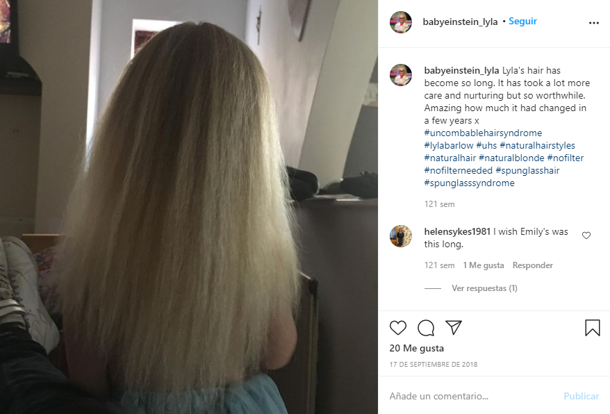 Una niña con el síndrome del cabello impeinable logra manejar su pelo ...