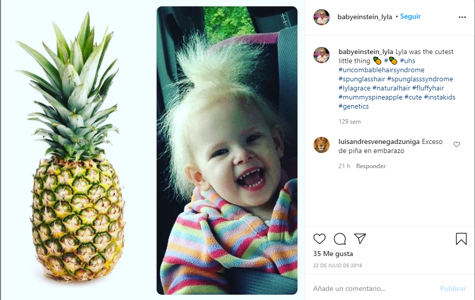 Una niña con el síndrome del cabello impeinable logra manejar su pelo ...